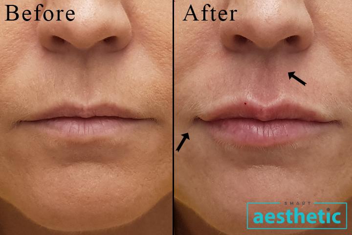 Nefertiti Neck Lift - Botox in NW10 London for £180.00 for sale | Shpock