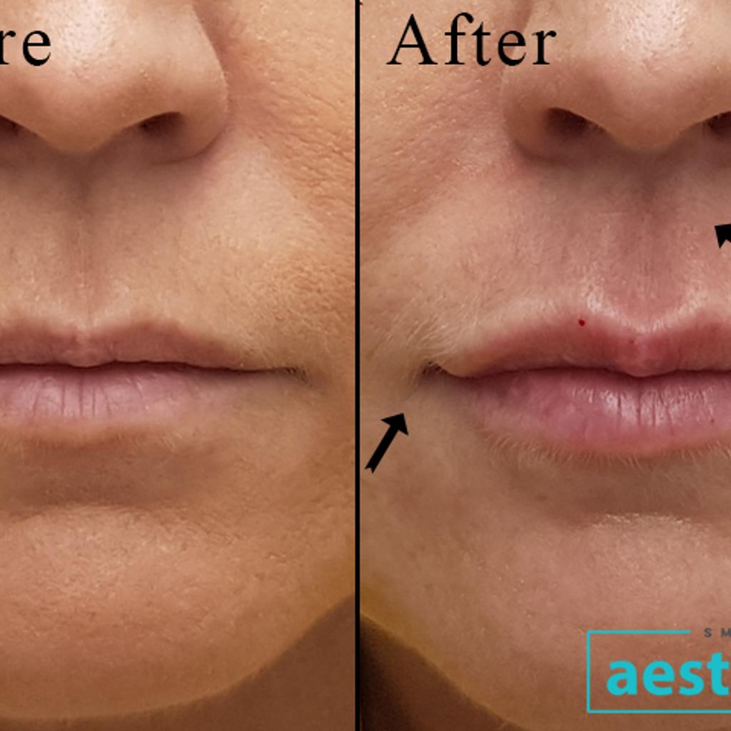 Nefertiti Neck Lift - Botox in NW10 London for £180.00 for sale | Shpock