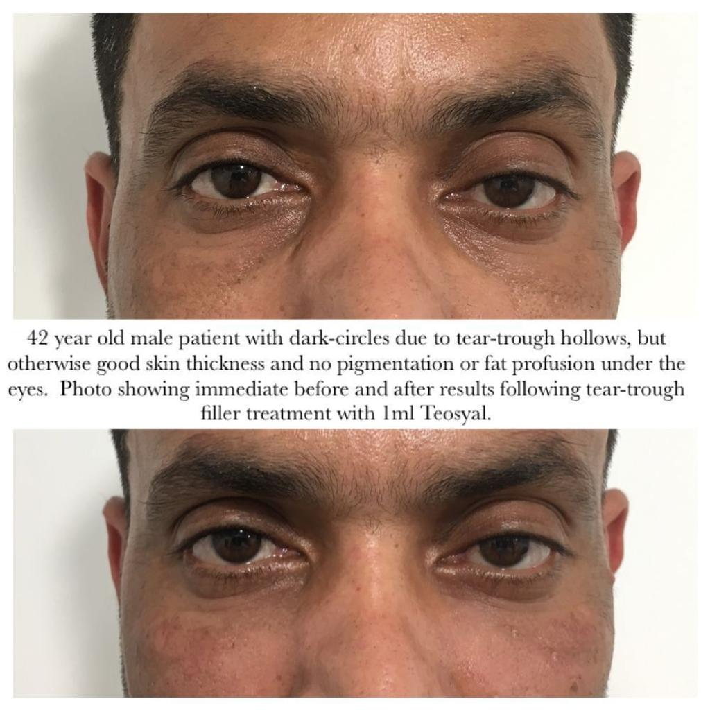 Tear-trough Filler (Dark-circle Treatment) in NW8 London für £ 190,00 ...